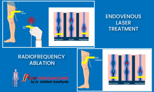 Endovenous Laser Ablation versus Radiofrequency Ablation -Dr.Abhilash | Dr Abhilash